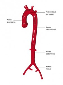 Chirurgie aortique | Groupe Vasculaire Lyon